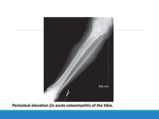 Bone and Joint Infections PPT BY DR.BP .PPT