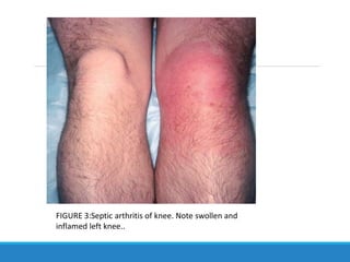 Bone and Joint Infections PPT by dr.bp.pptx