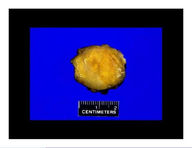 Bone and soft tissue pathology | PPTX