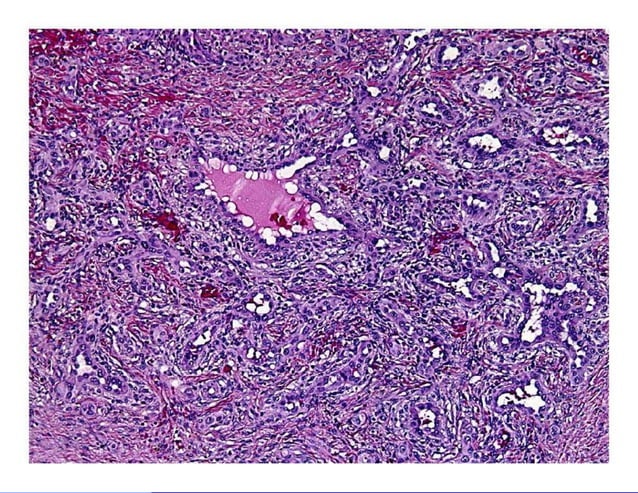 Bone and soft tissue pathology | PPTX
