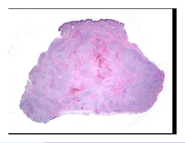 Bone and soft tissue pathology | PPTX