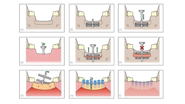 Bone augmentation in periodontology.pptx