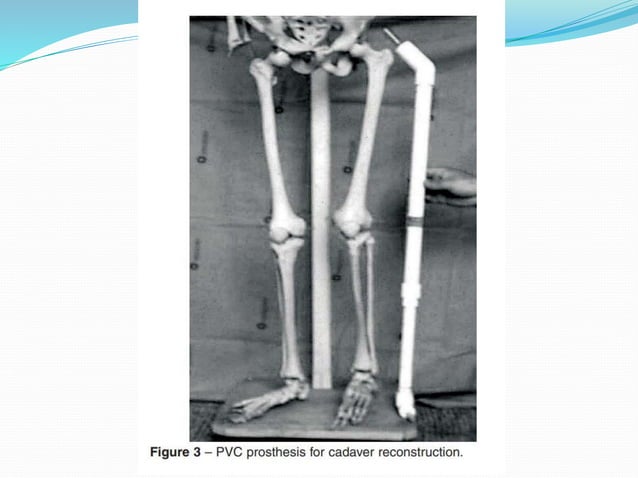 BONE BANK.pptx | Bone and Joint Conditions | Diseases and Conditions