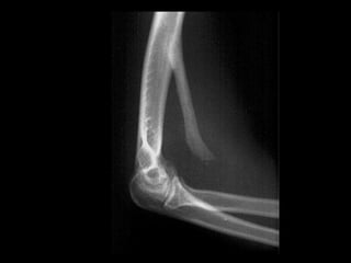 Bone cases,Needles, Catheters, Drains, wires | PPT