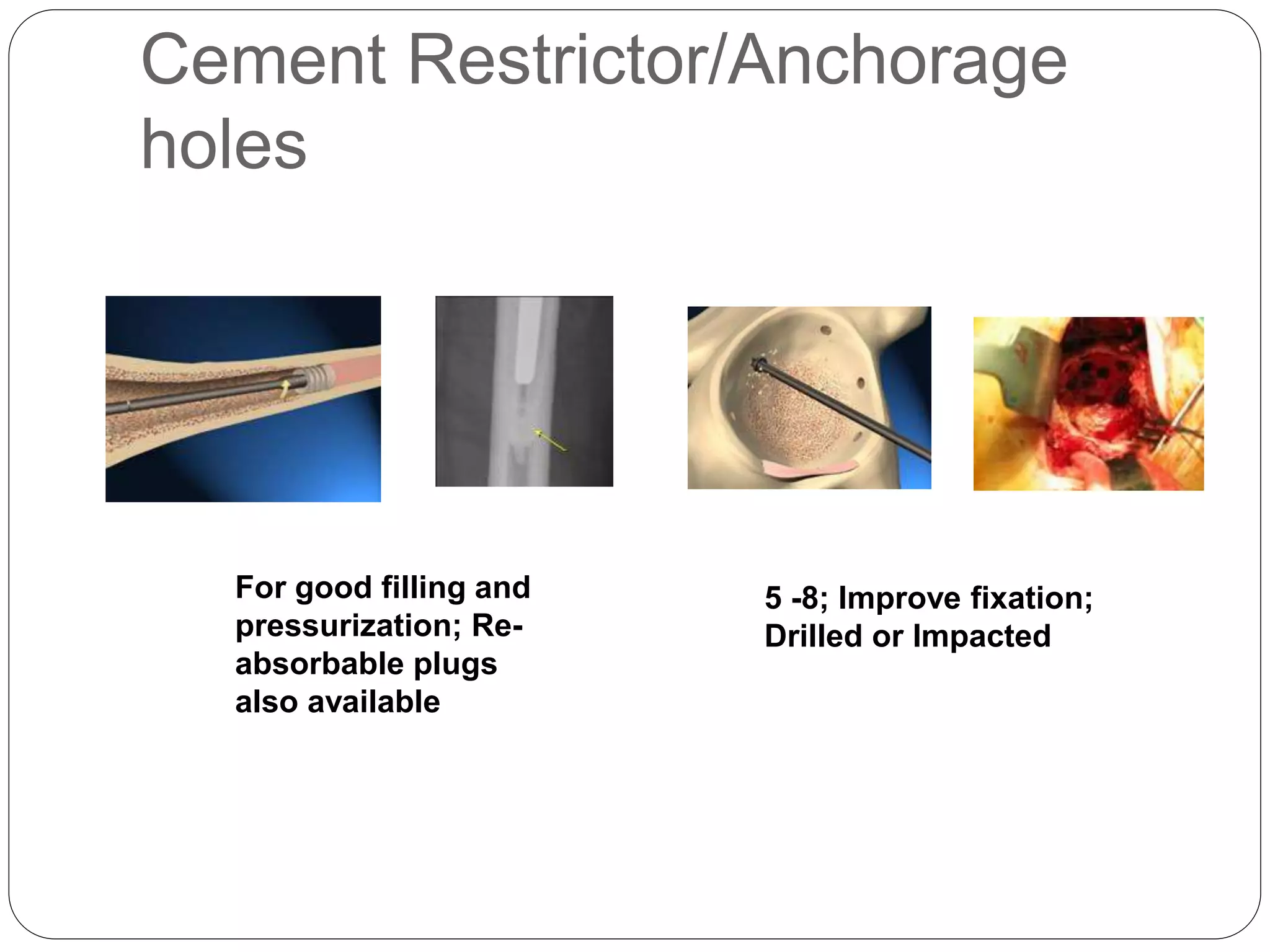 Bonecement CR teaching | PPTX
