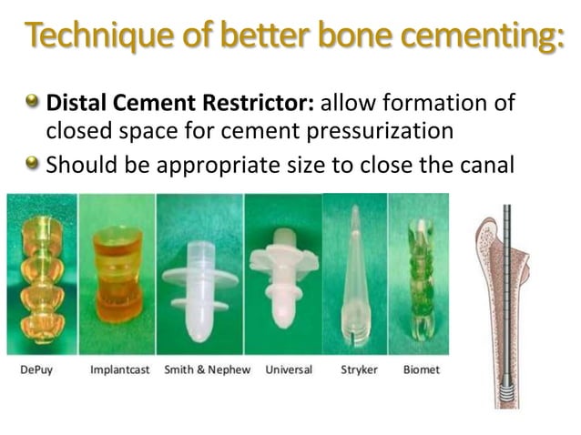 Bone cement | PPTX | Bone and Joint Conditions | Diseases and Conditions