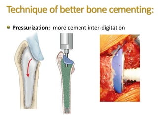 Bone cement | PPTX
