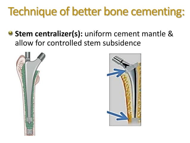 Bone cement | PPTX | Bone and Joint Conditions | Diseases and Conditions