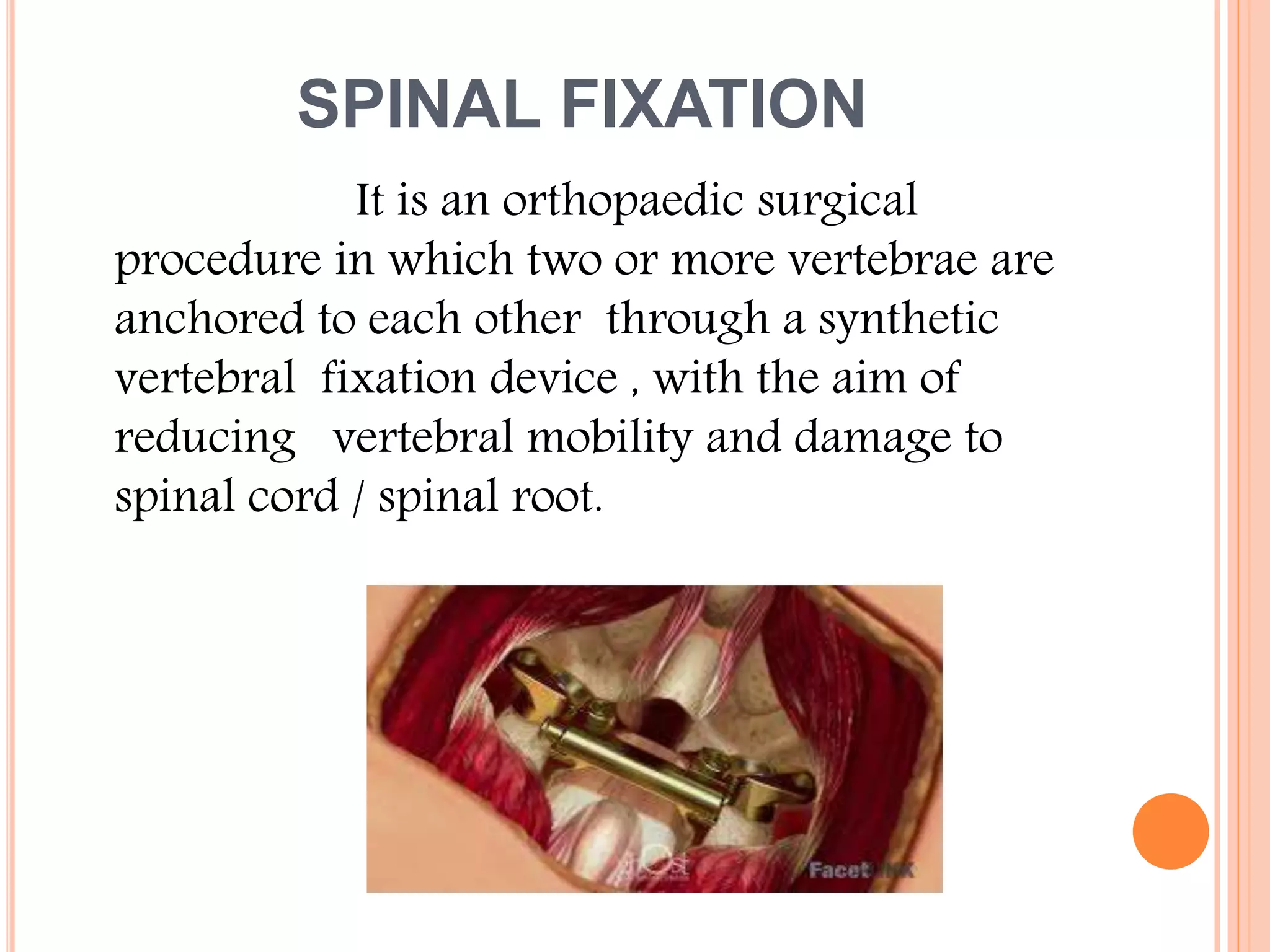 Bone cement and spinal fixation | PPTX