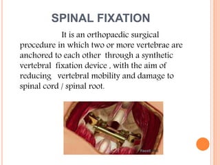 Bone cement and spinal fixation | PPTX