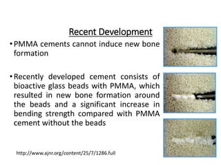 Bone cement | PPTX