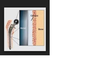 Bone Cement Implantation Syndrome & management.pptx