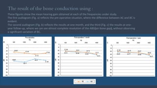 Bone conduction | PDF