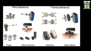 Bone Conduction Hearing Devices(BCHDs) | PPT