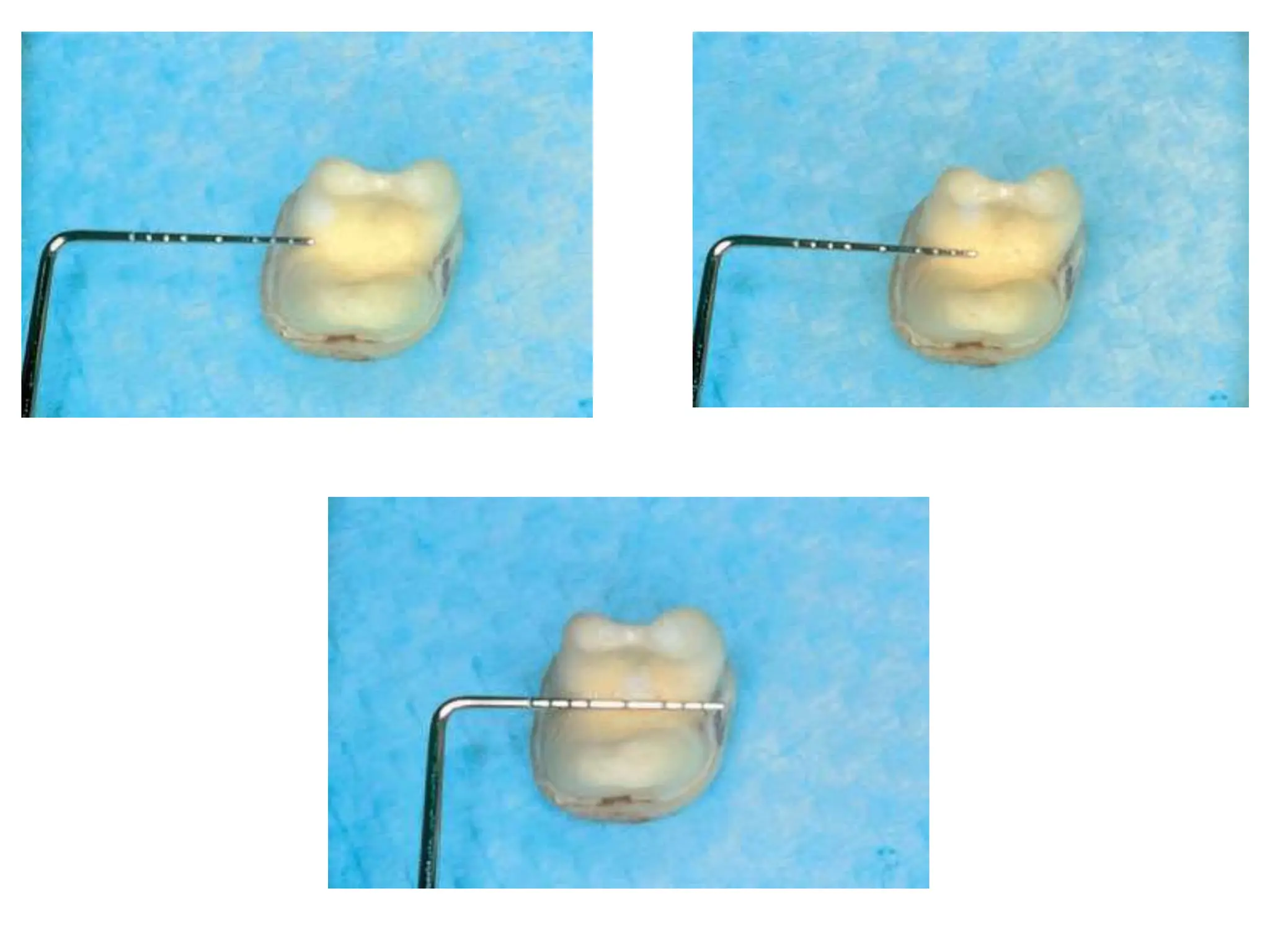 Bone Defects in different Periodontal disease.pptx | Bone and Joint ...