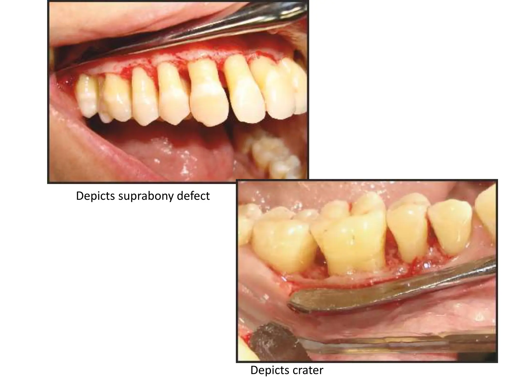 Bone Defects in different Periodontal disease.pptx | Bone and Joint ...