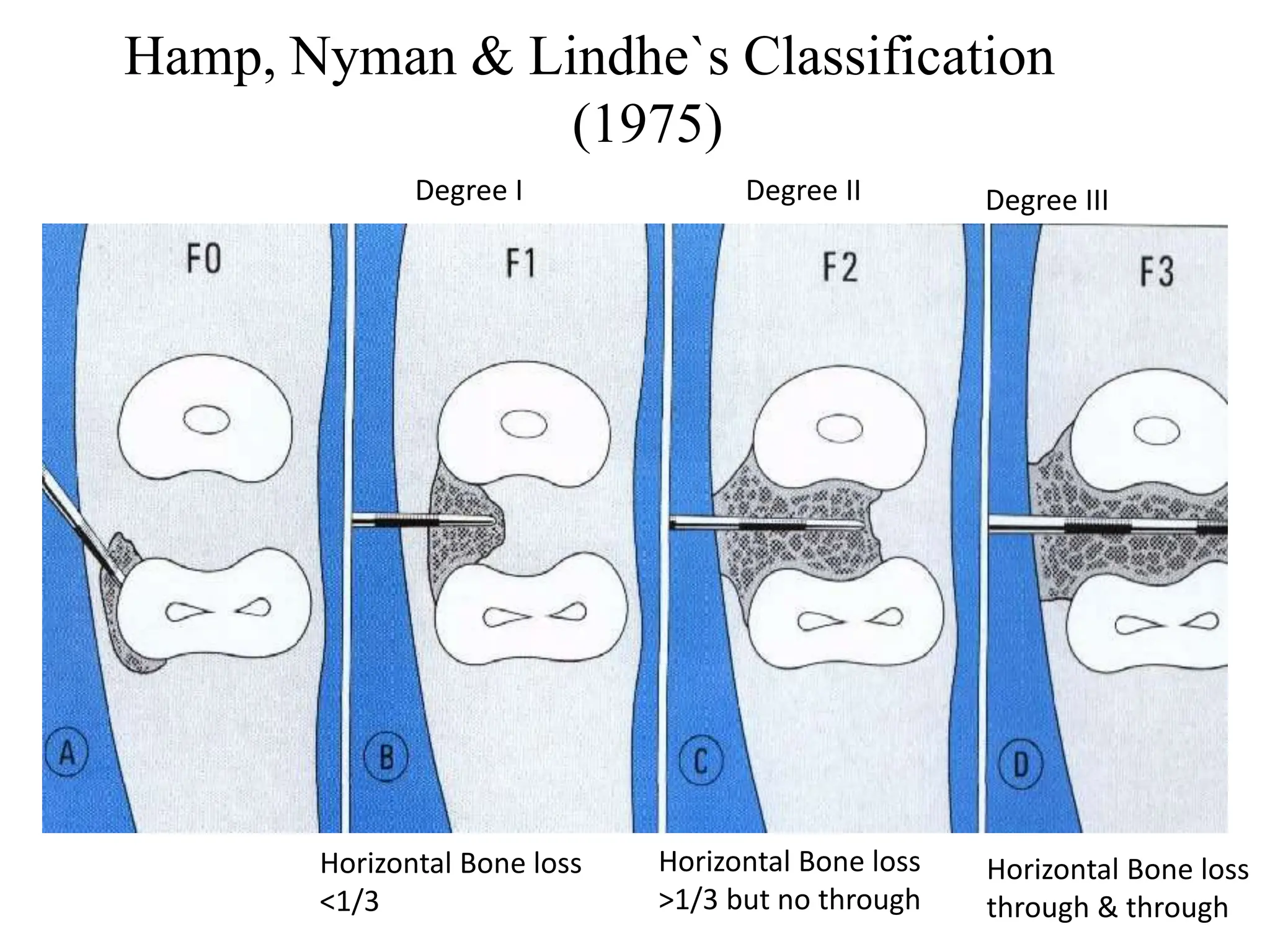 Bone Defects in different Periodontal disease.pptx | Bone and Joint ...