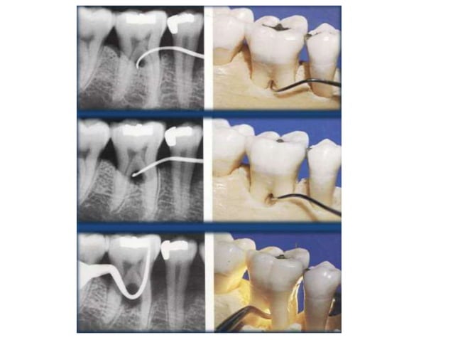 Bone Defects in different Periodontal disease.pptx | Bone and Joint ...