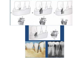 Bone Defects in different Periodontal disease.pptx | Bone and Joint ...