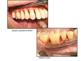 Bone Defects in different Periodontal disease.pptx | Bone and Joint ...