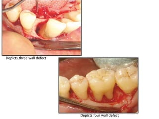 Bone Defects in different Periodontal disease.pptx | Bone and Joint ...