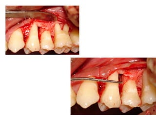 Bone Defects in different Periodontal disease.pptx | Bone and Joint ...