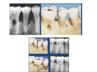 Bone Defects in different Periodontal disease.pptx | Bone and Joint ...