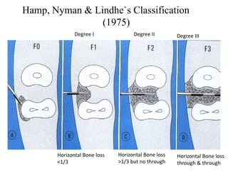 Bone Defects in different Periodontal disease.pptx | Bone and Joint ...