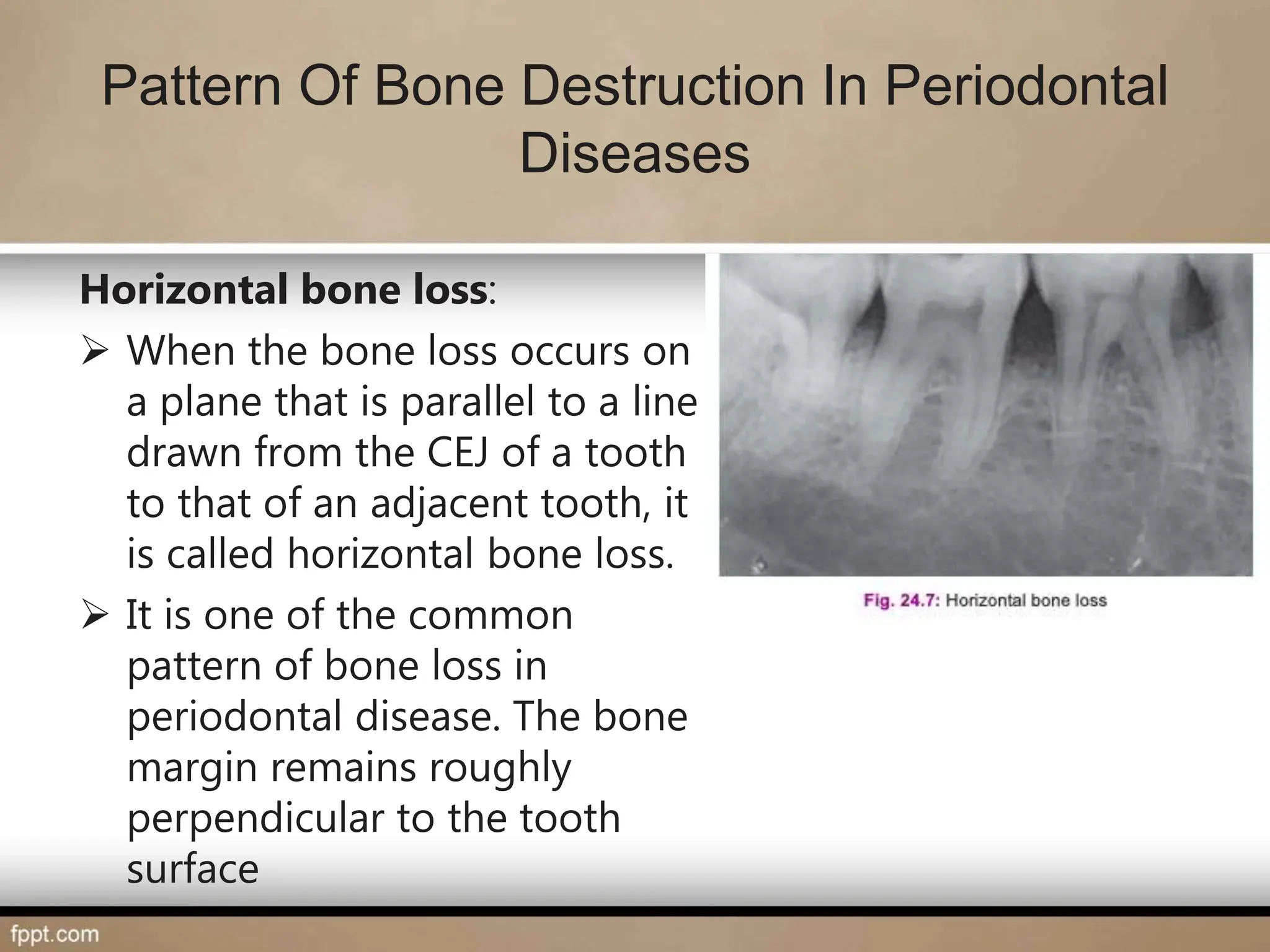 BONE DEFECTS lecture in periodontology. | PPTX