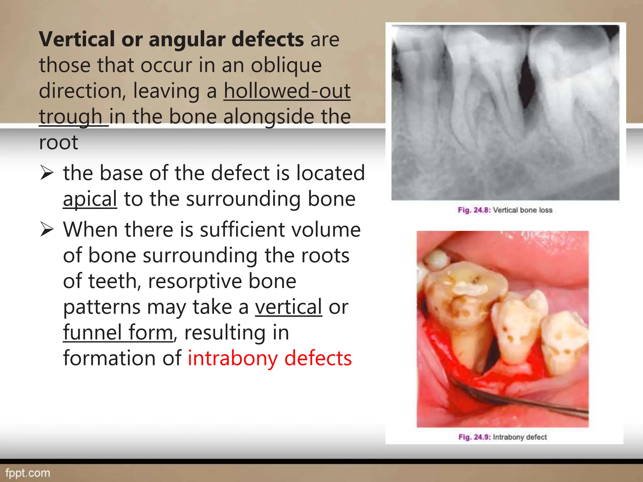 BONE DEFECTS lecture in periodontology. | PPTX
