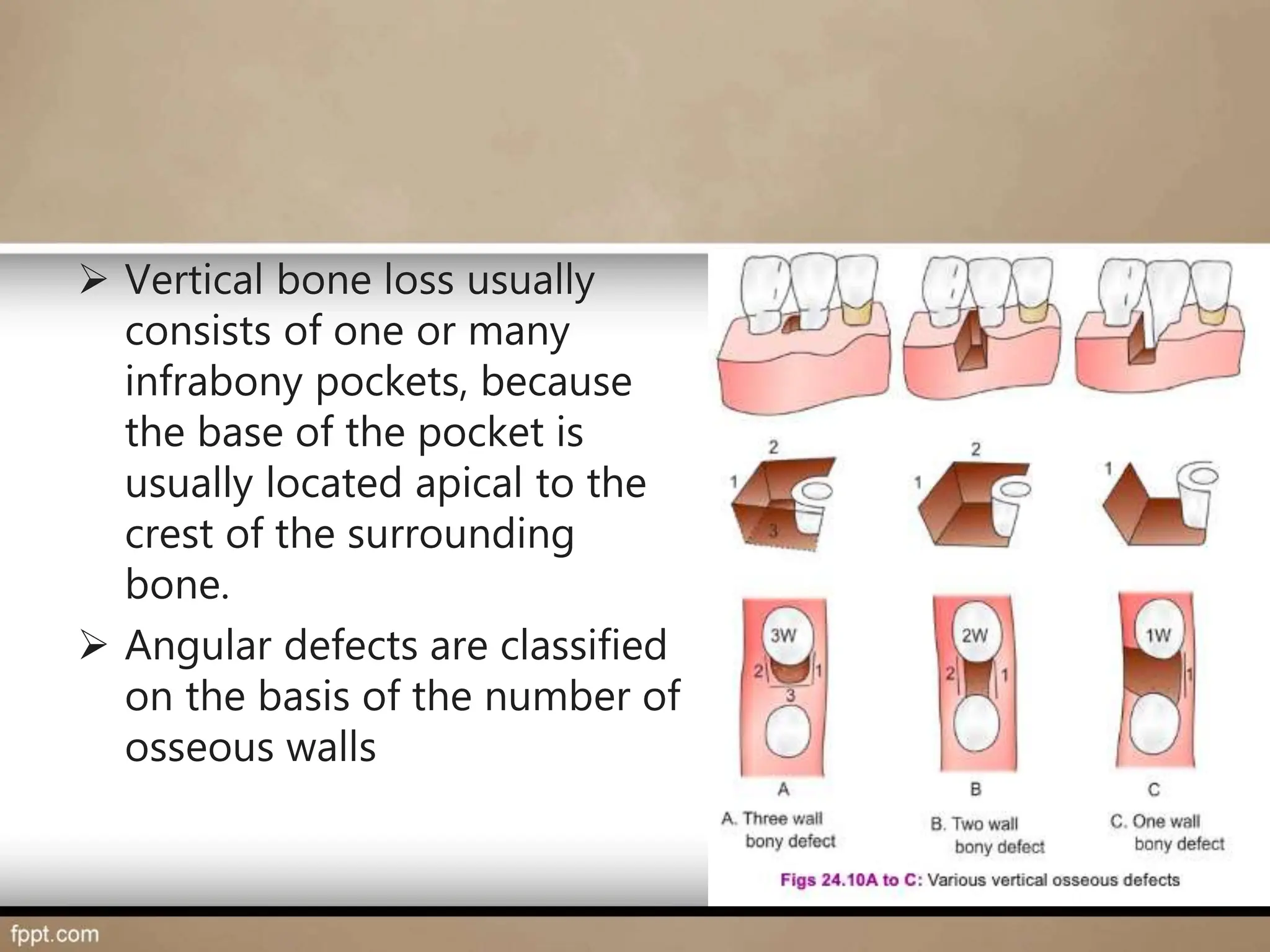 BONE DEFECTS lecture in periodontology. | PPTX