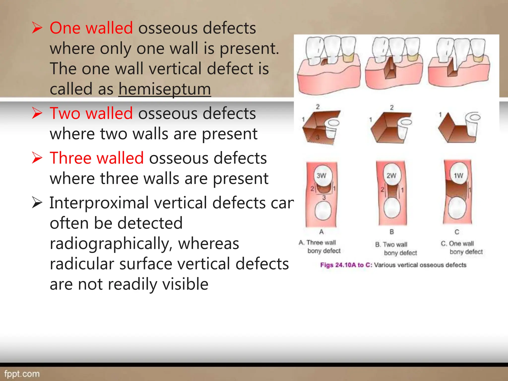 BONE DEFECTS lecture in periodontology. | PPTX