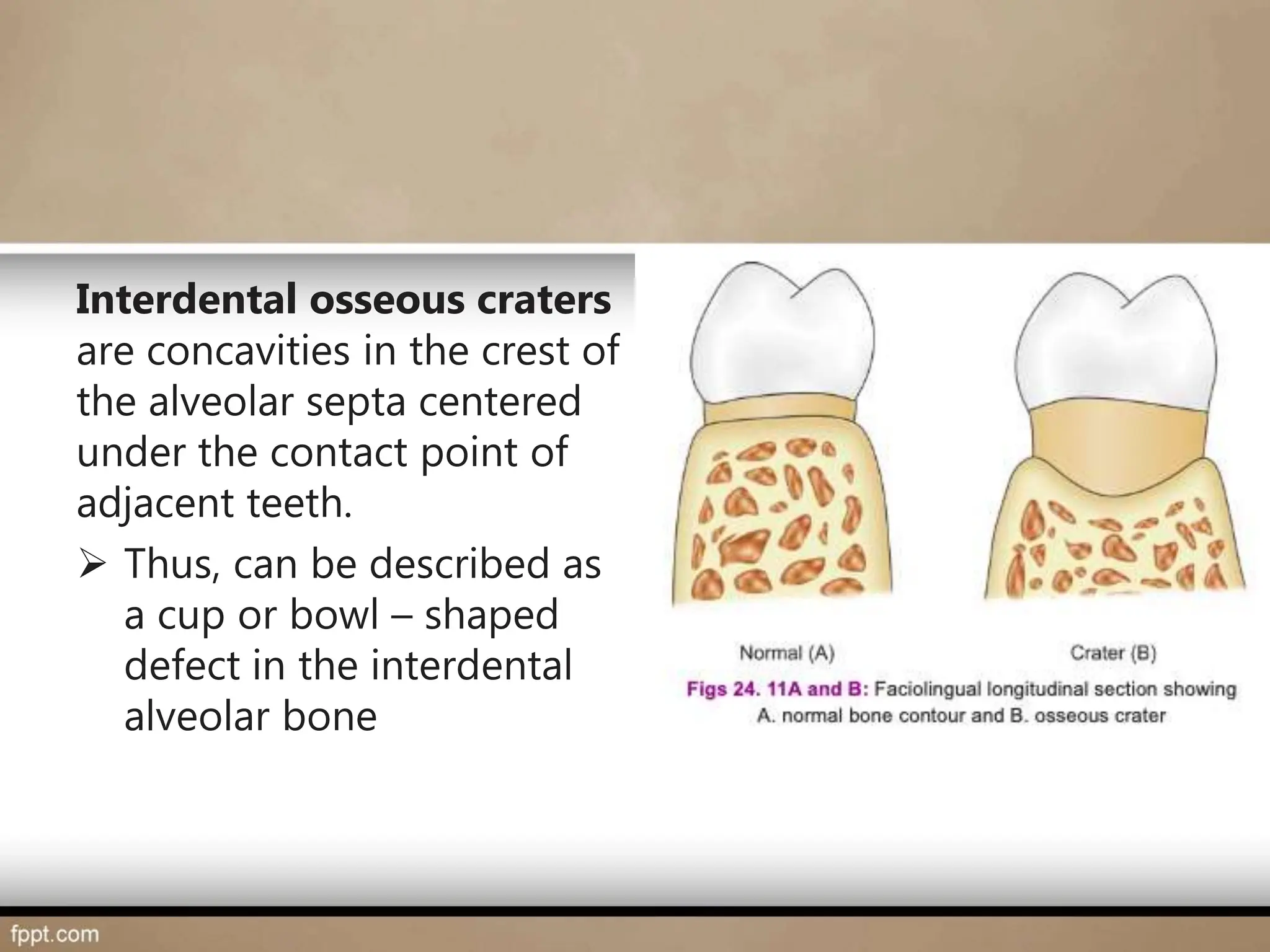 BONE DEFECTS lecture in periodontology. | PPTX