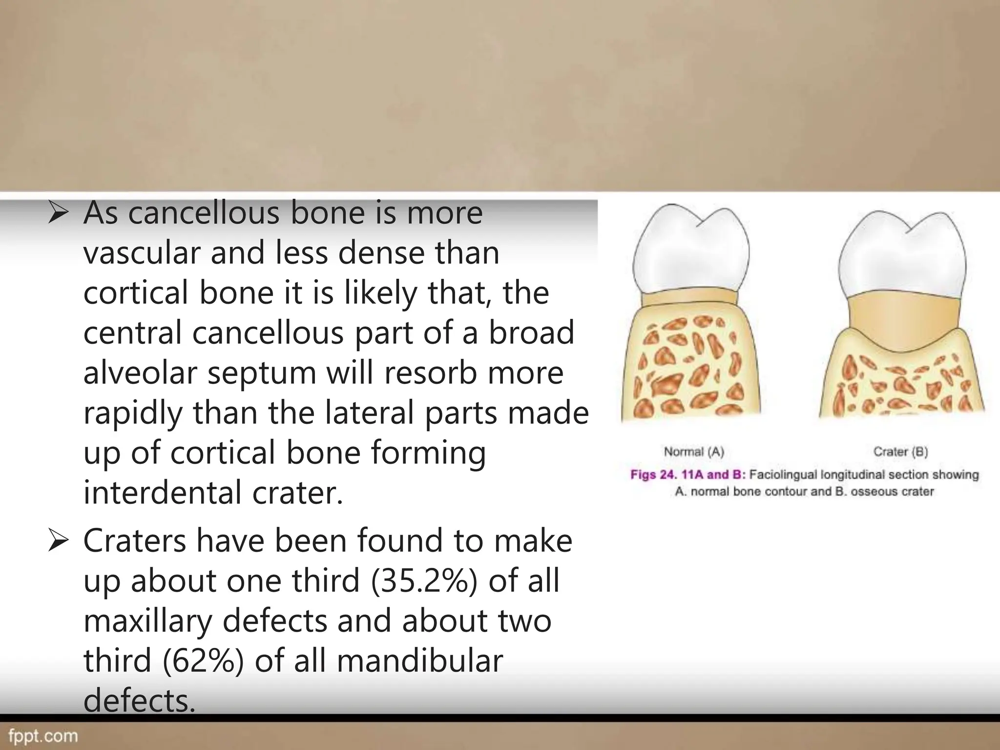 BONE DEFECTS lecture in periodontology. | PPTX