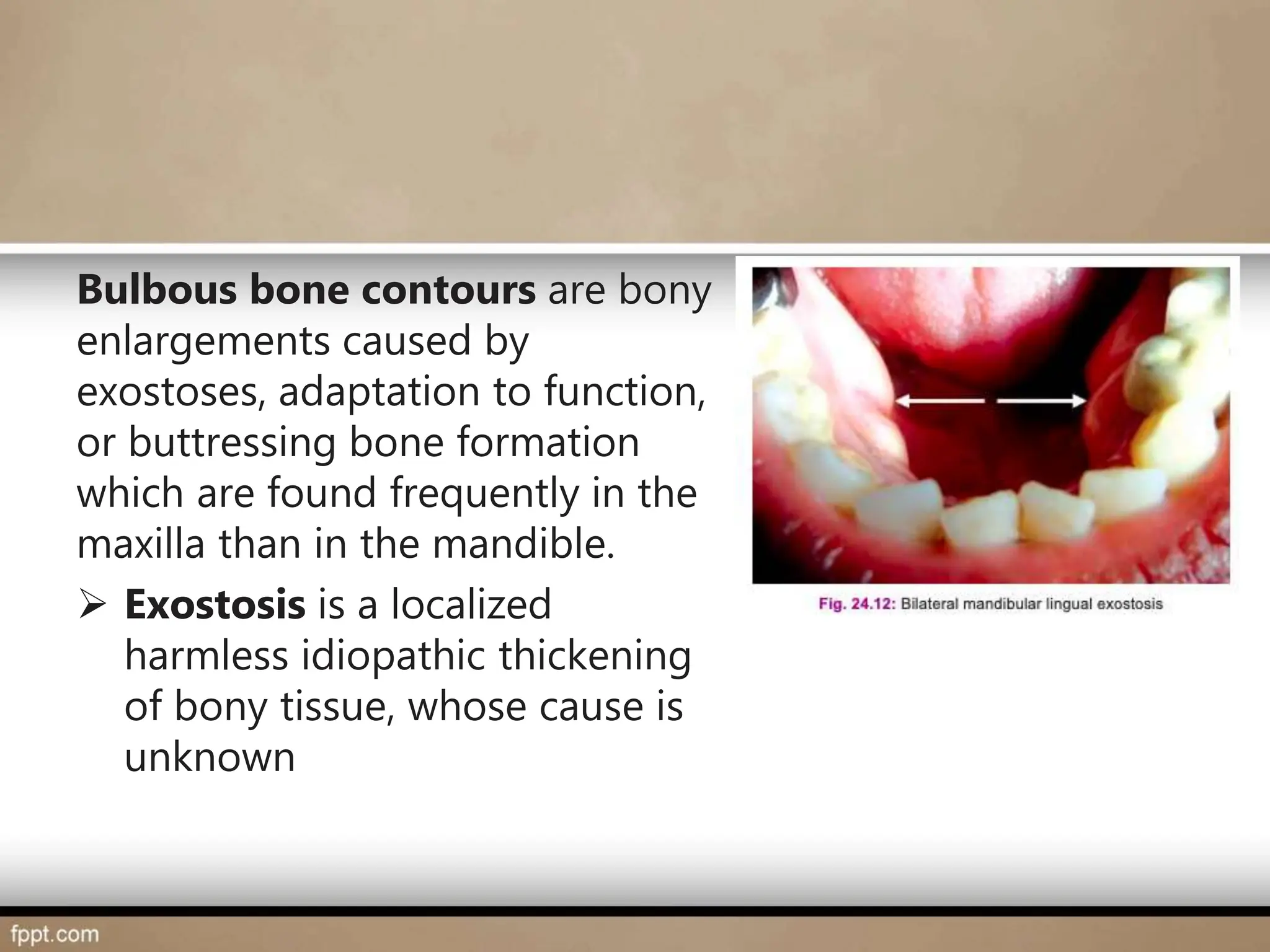 BONE DEFECTS lecture in periodontology. | PPTX