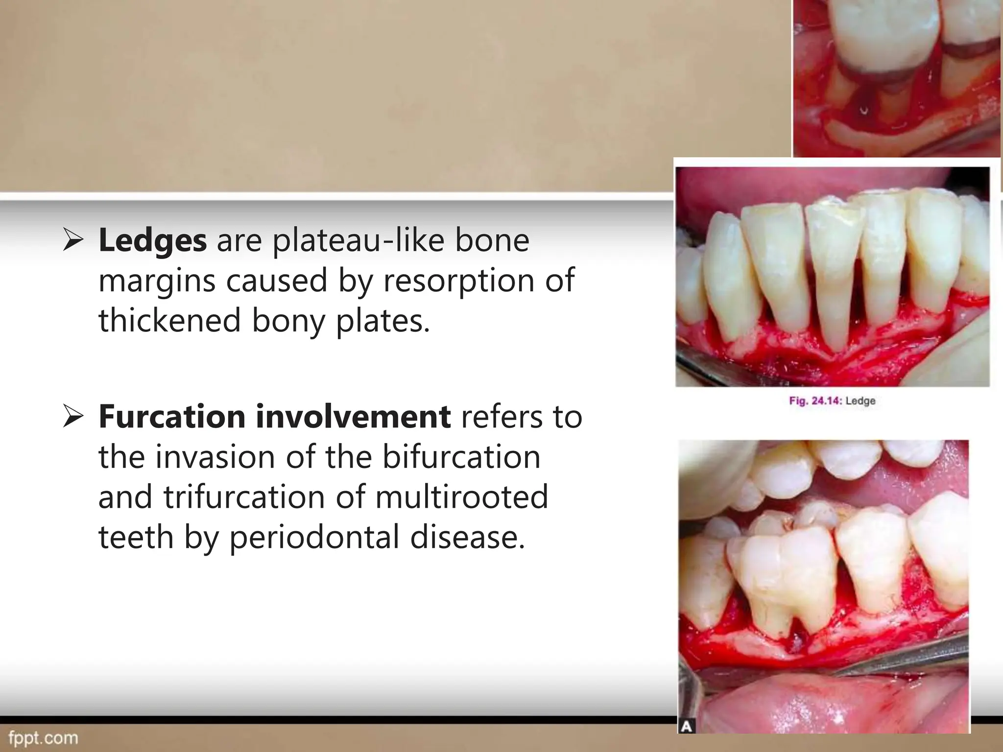 BONE DEFECTS lecture in periodontology. | PPTX