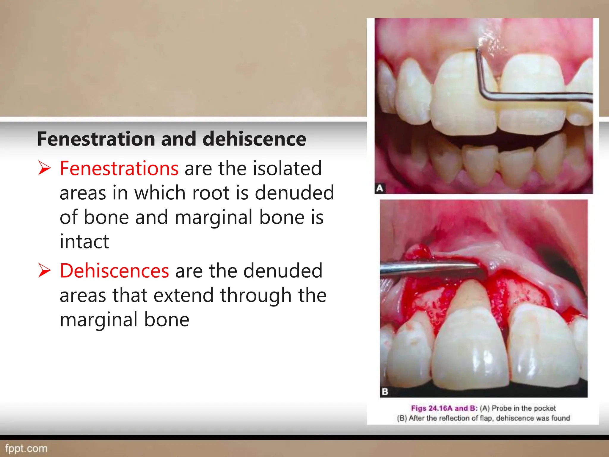 BONE DEFECTS lecture in periodontology. | PPTX