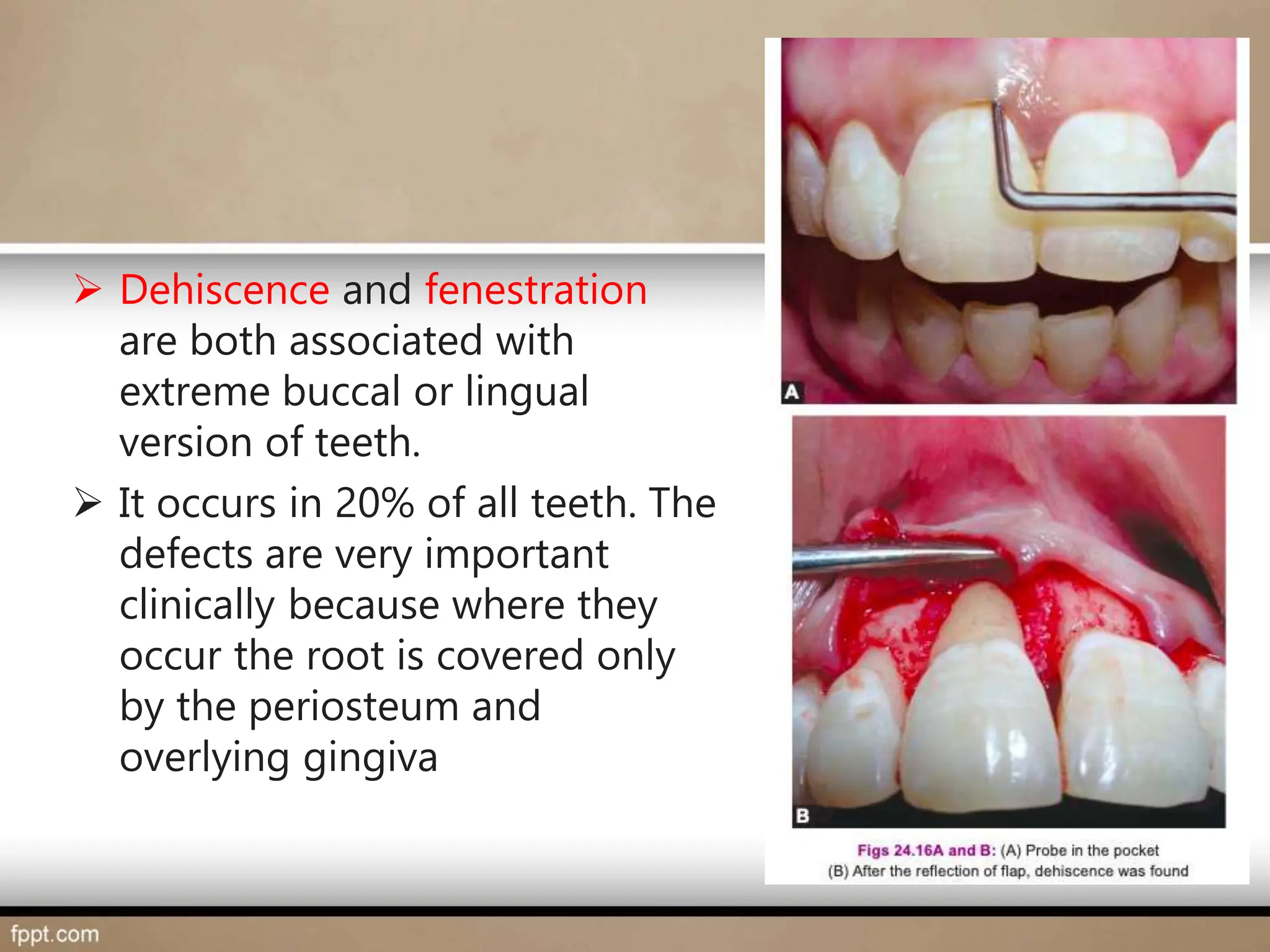 BONE DEFECTS lecture in periodontology. | PPTX