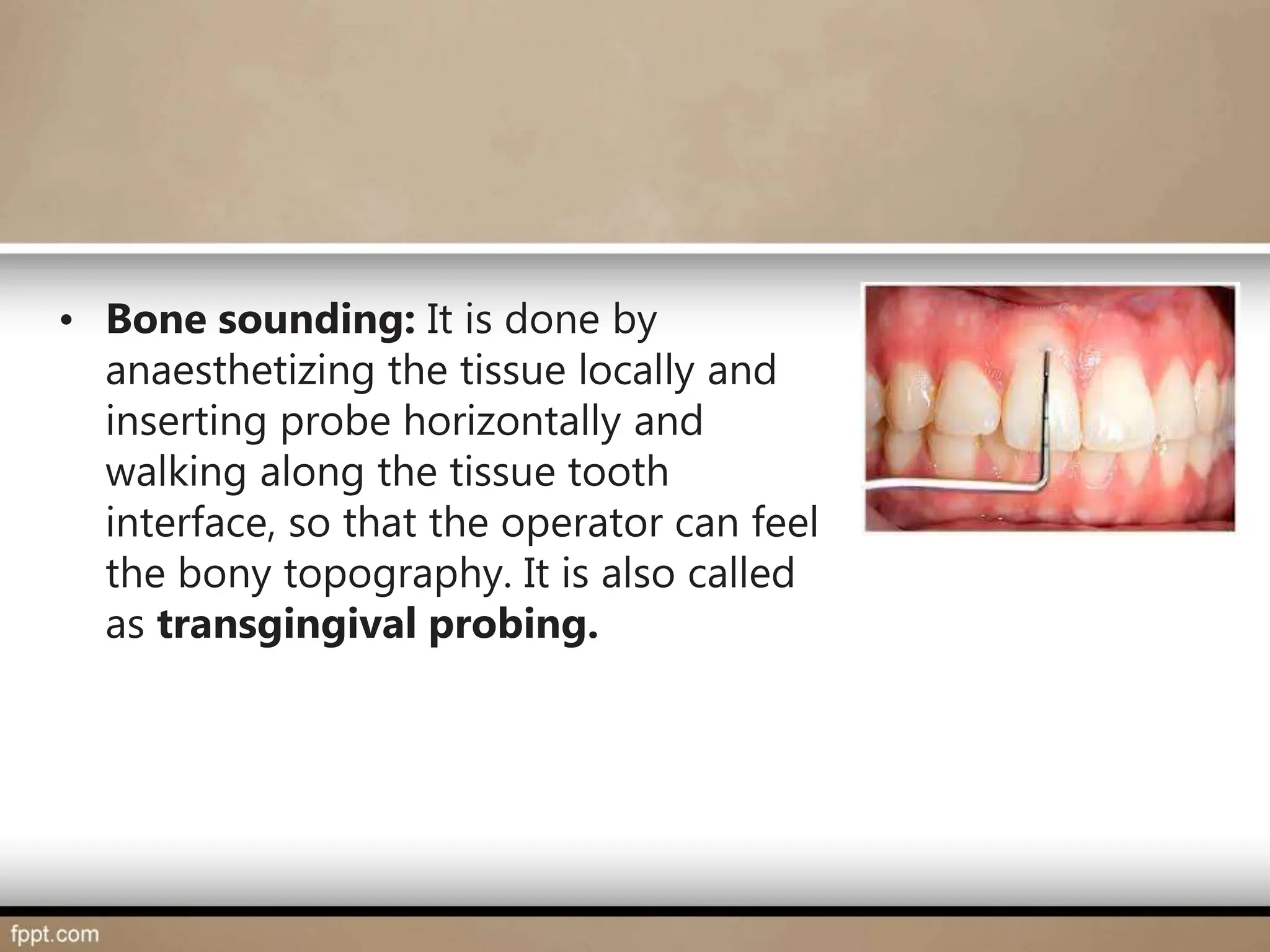 BONE DEFECTS lecture in periodontology. | PPTX