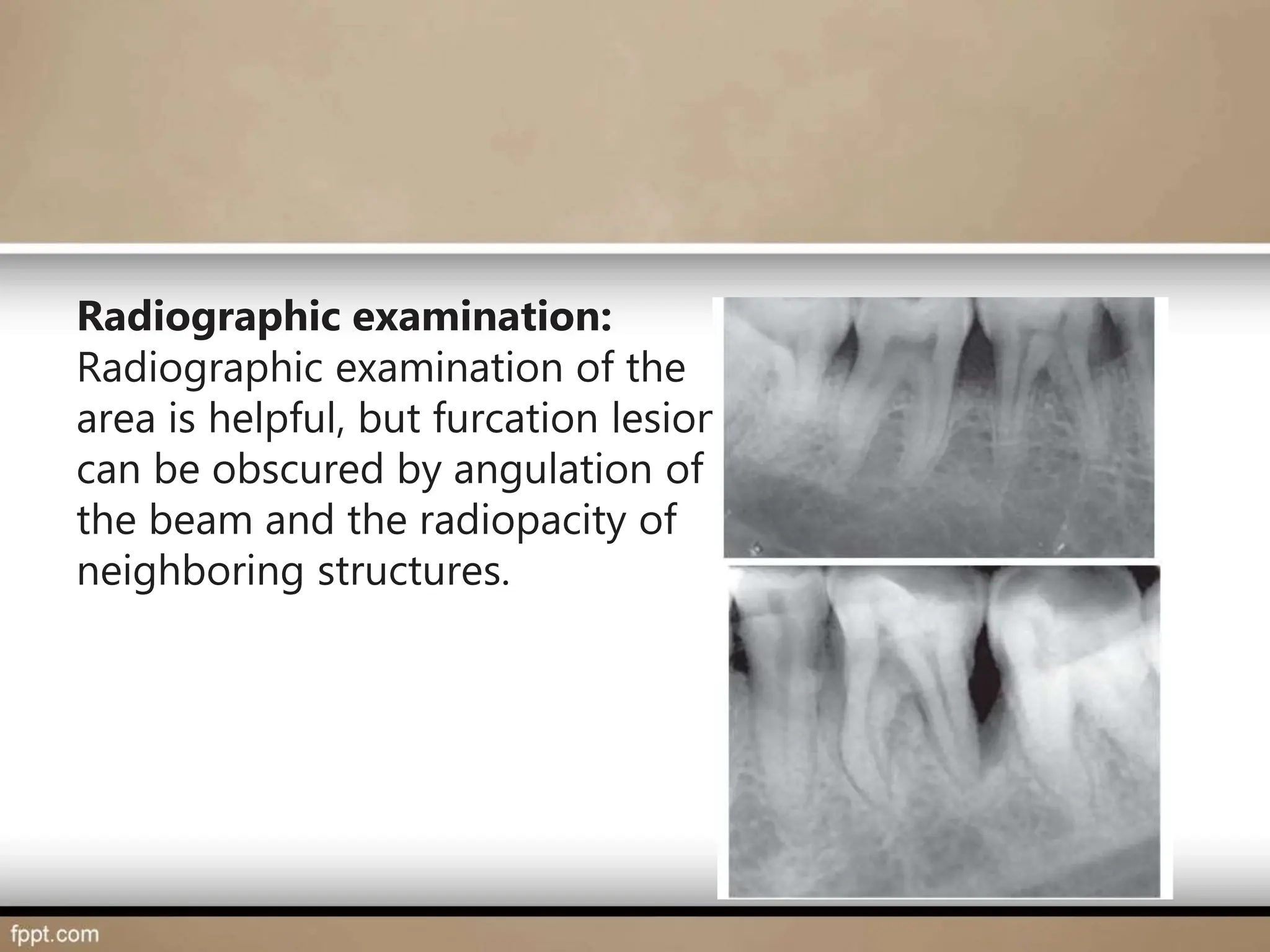 BONE DEFECTS lecture in periodontology. | PPTX