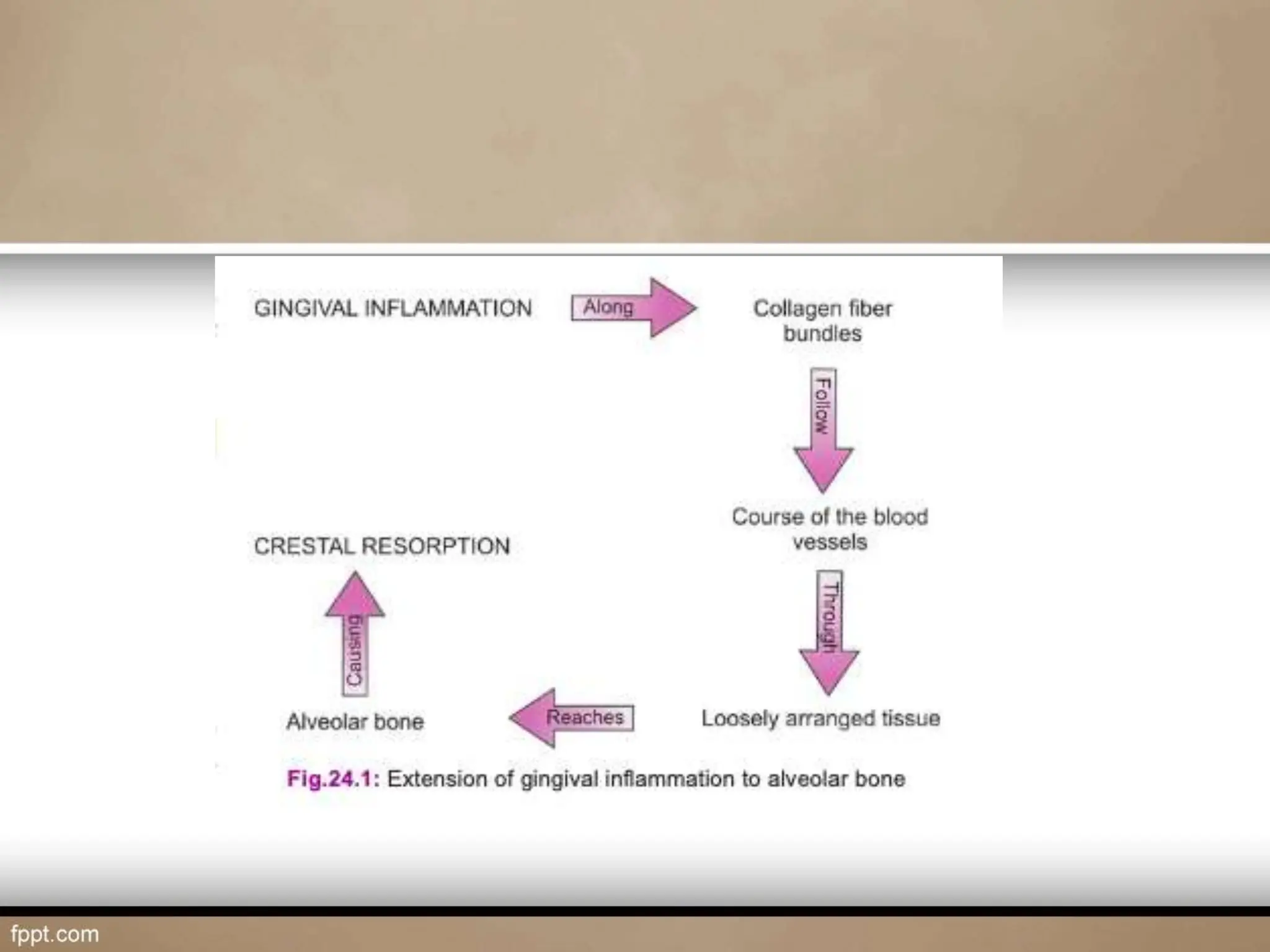 BONE DEFECTS lecture in periodontology. | PPTX