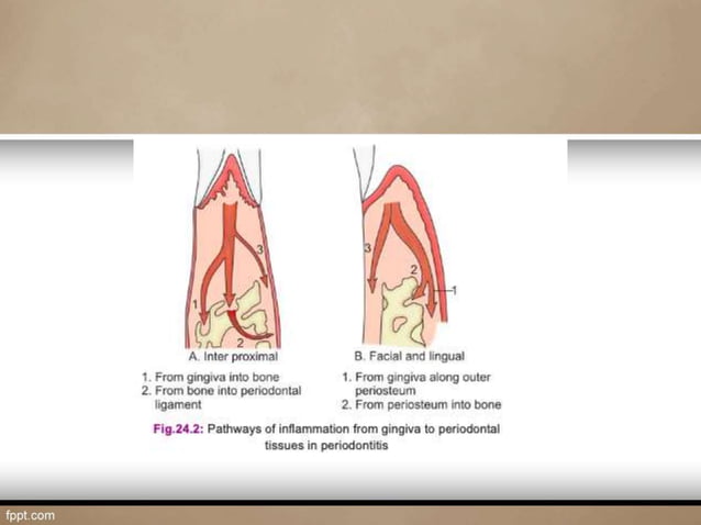 BONE DEFECTS lecture in periodontology. | PPTX | Dental Health ...