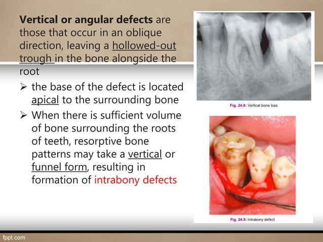 BONE DEFECTS lecture in periodontology. | PPTX | Dental Health ...