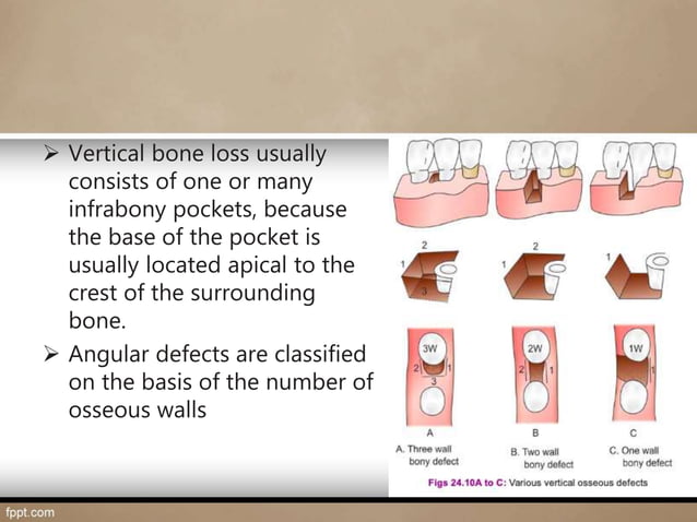 BONE DEFECTS lecture in periodontology. | PPTX | Dental Health ...