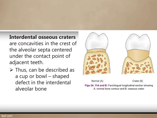BONE DEFECTS lecture in periodontology. | PPTX | Dental Health ...