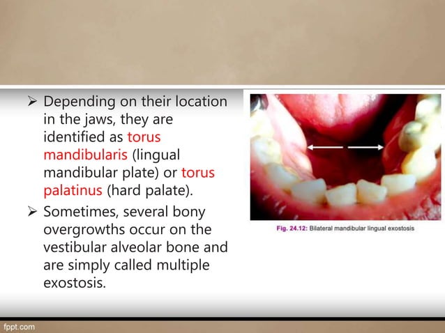BONE DEFECTS lecture in periodontology. | PPTX | Dental Health ...