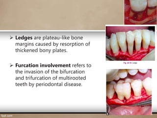 BONE DEFECTS lecture in periodontology. | PPTX