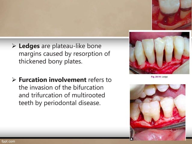BONE DEFECTS lecture in periodontology. | PPTX | Dental Health ...
