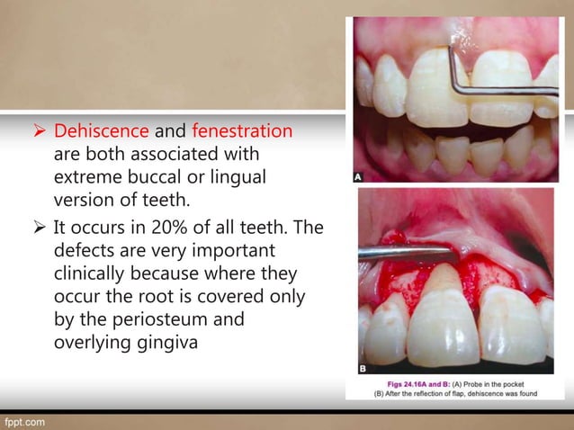 BONE DEFECTS lecture in periodontology. | PPTX | Dental Health ...