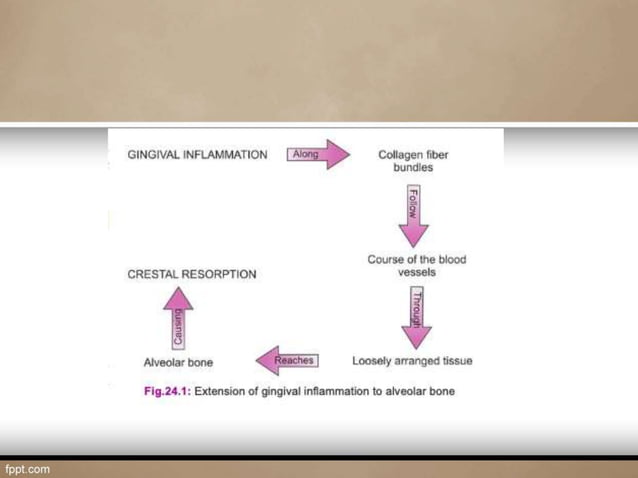 BONE DEFECTS lecture in periodontology. | PPTX | Dental Health ...